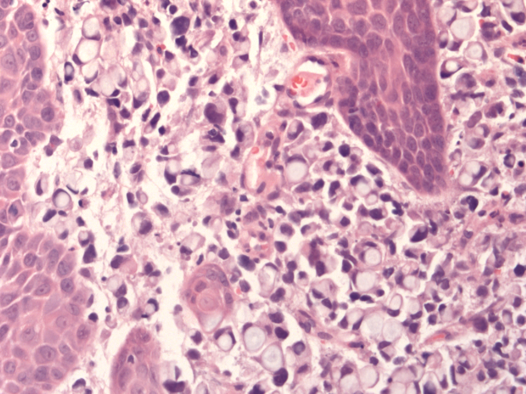17 1 67838 Oes adenoca signet ring 2 | London GI Pathology Update